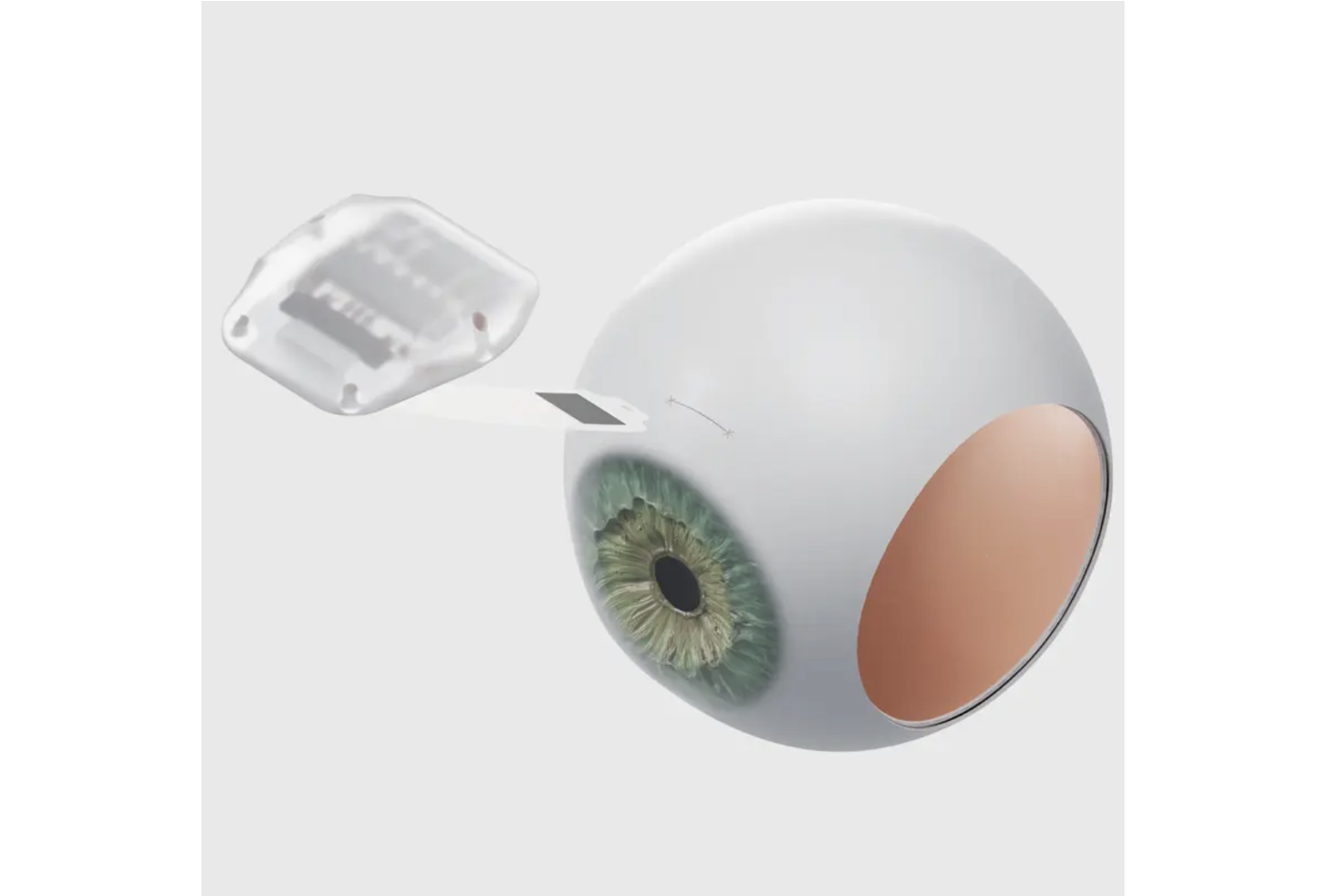 能植入眼睛！Science Corp. 開發「Micro LED 視覺假體」可替換人眼 | TechNews 科技新報